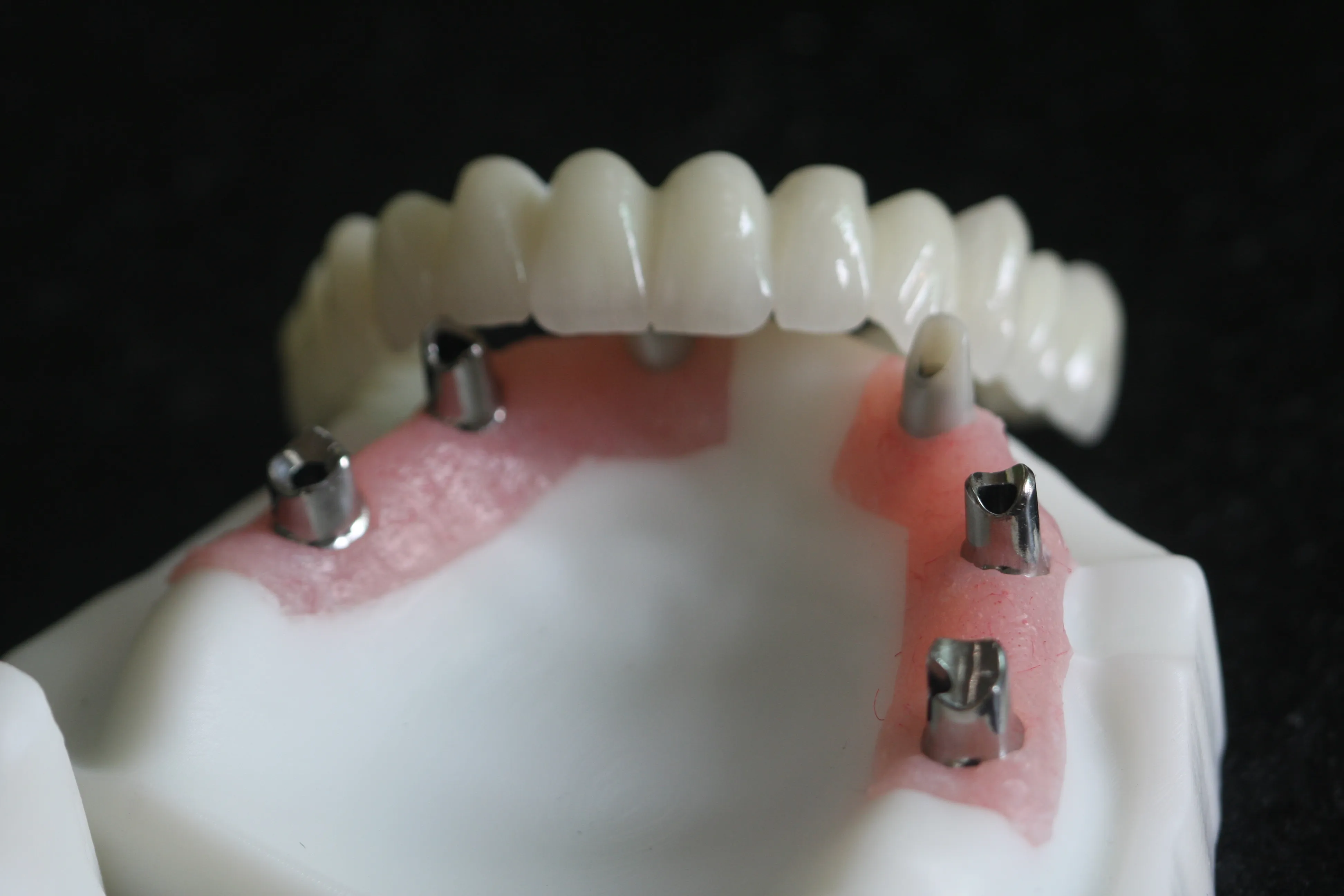 Dental Crowns, Implant, Zirconia, PFM, Denture | Company Name